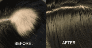 Regrow Thicker Hair with DERIVE Hair Restoration in Ridgeland, MS