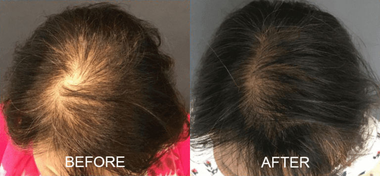 Regrow Thicker Hair with DERIVE Hair Restoration in Ridgeland, MS